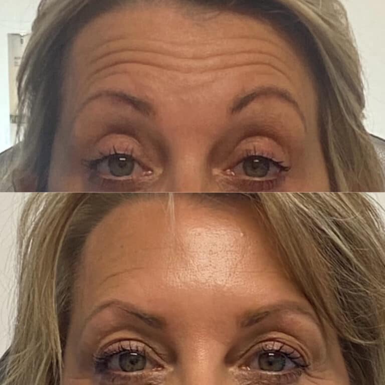 Botox Injections Cedar Park | AustinMD Aesthetics | Leander